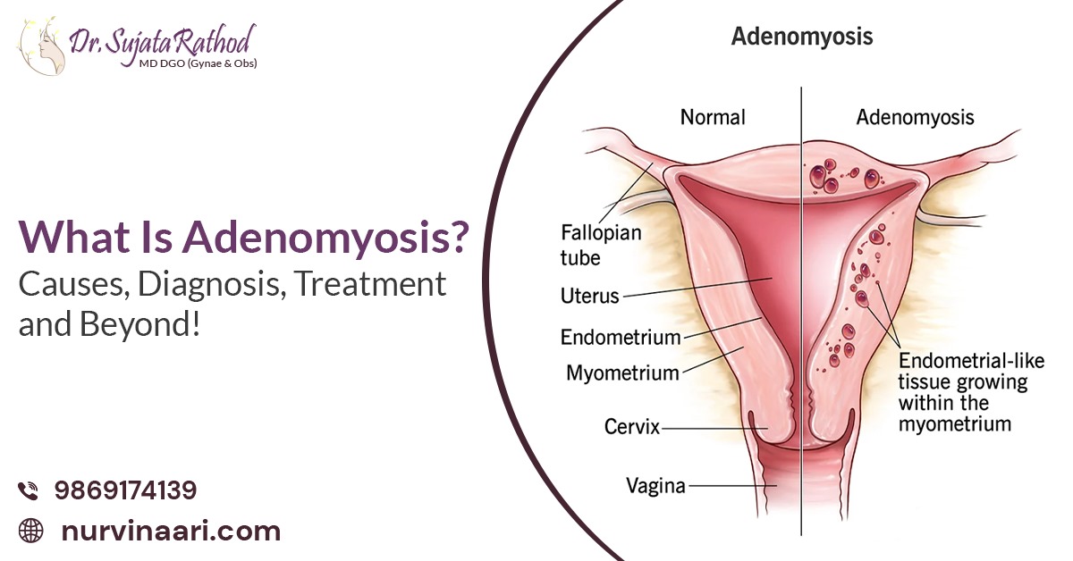 Decoding Adenomyosis Causes Diagnosis Treatment And More 2045