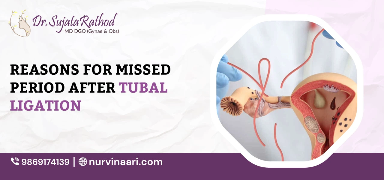 Reasons for Missed Period After Tubal Ligation